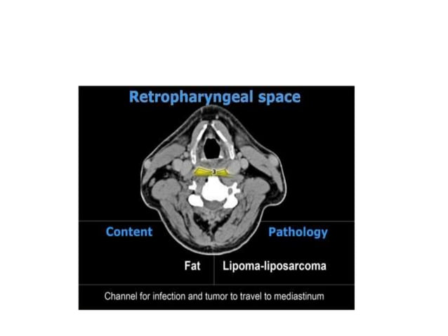 Radiological approach to neck spaces | PPTX