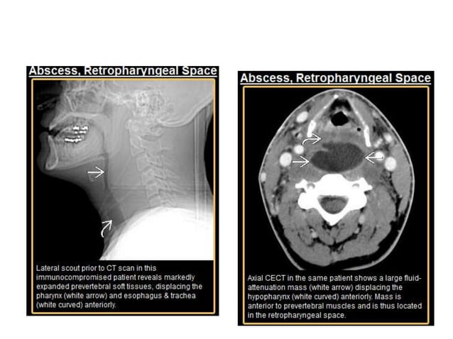 Radiological approach to neck spaces | PPTX