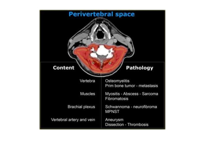 Radiological approach to neck spaces | PPTX