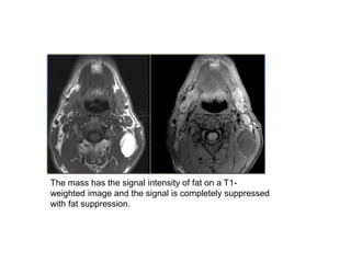 Radiological approach to neck spaces | PPTX