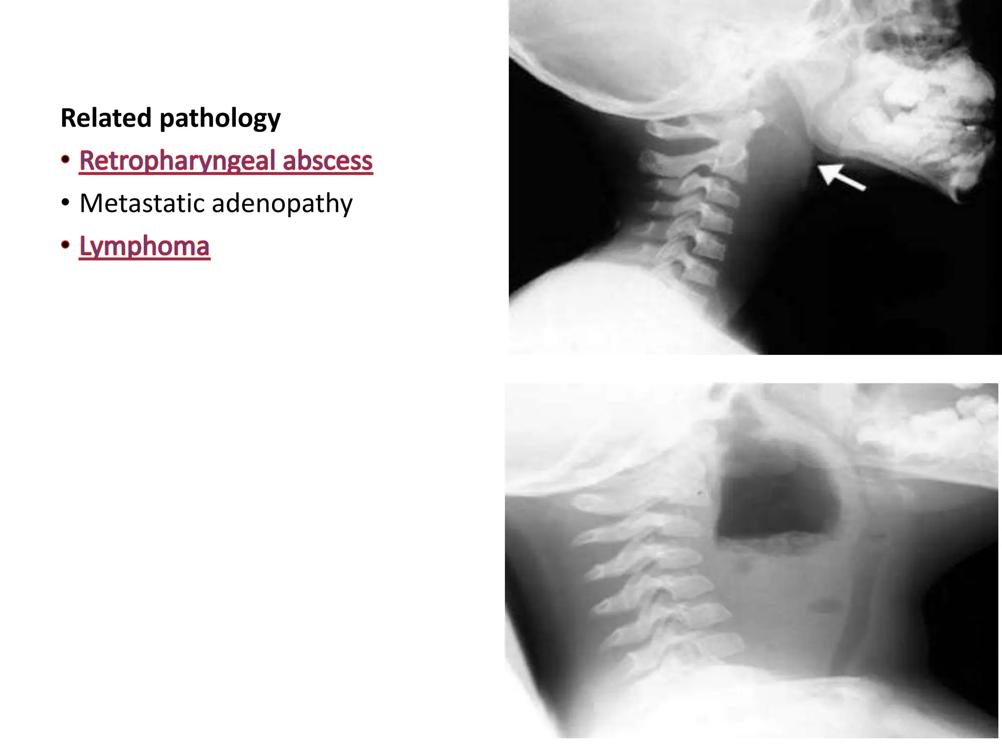 Anatomy of Deep Neck spaces Radiology Pictorial representation | PPTX