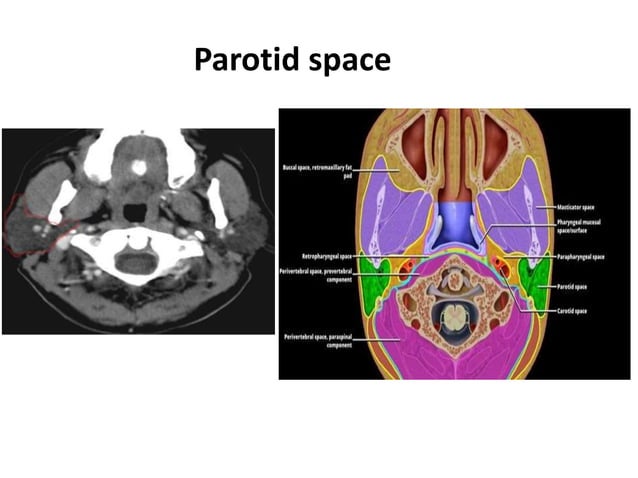 Anatomy of Deep Neck spaces Radiology Pictorial representation | PPTX
