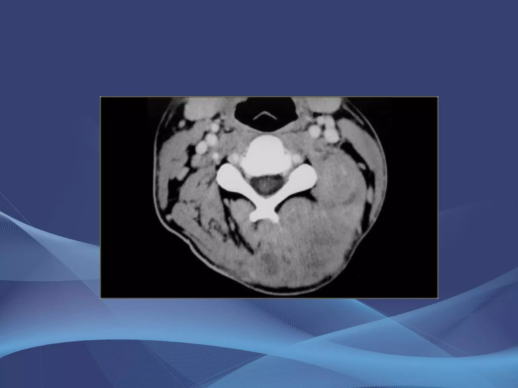 Anatomy of neck spaces and levels of cervical | PPT