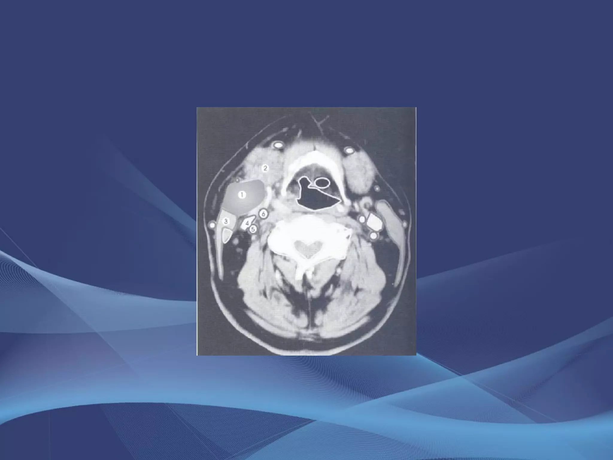 Anatomy of neck spaces and levels of cervical | PPT