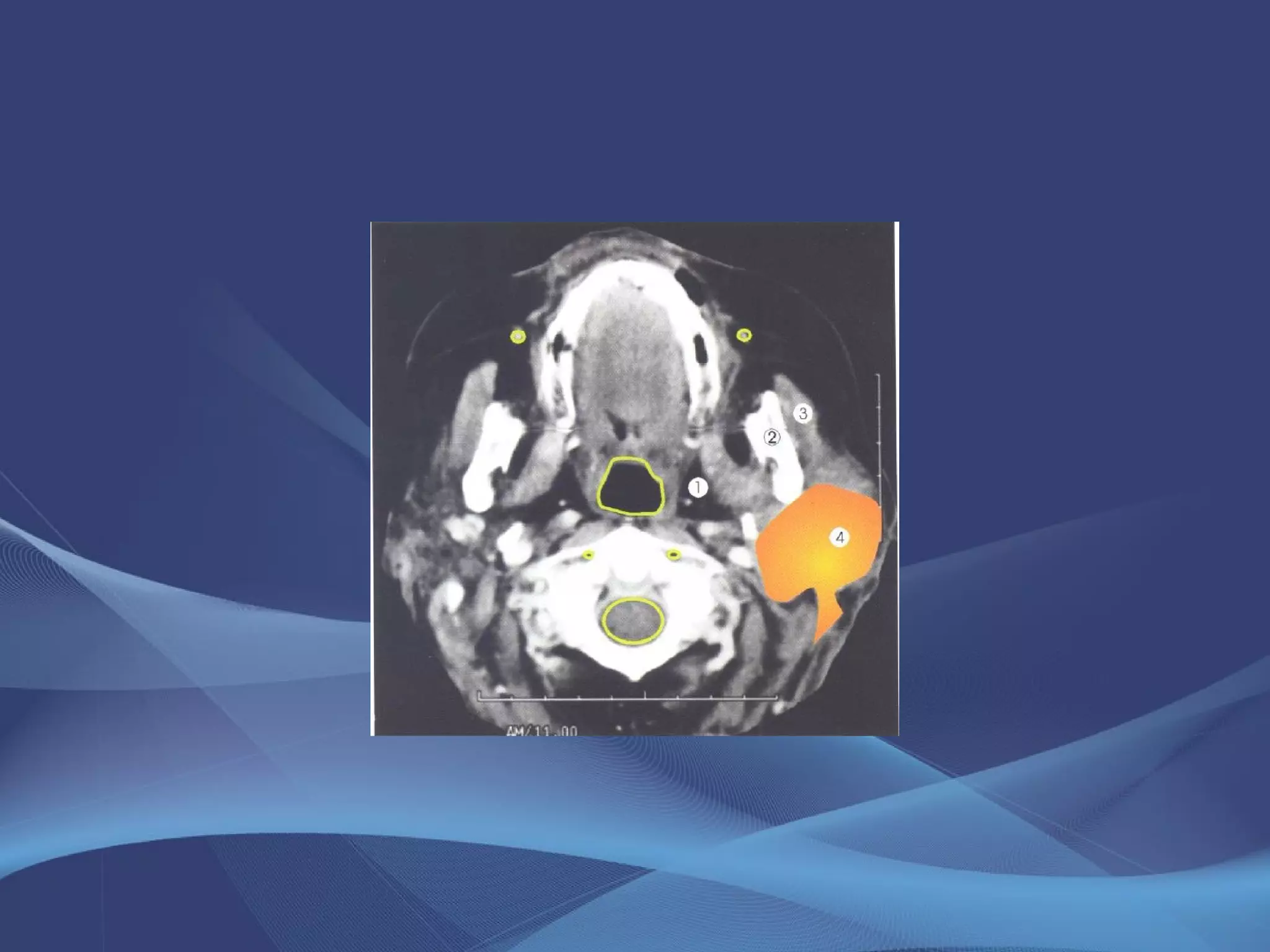 Anatomy of neck spaces and levels of cervical | PPT
