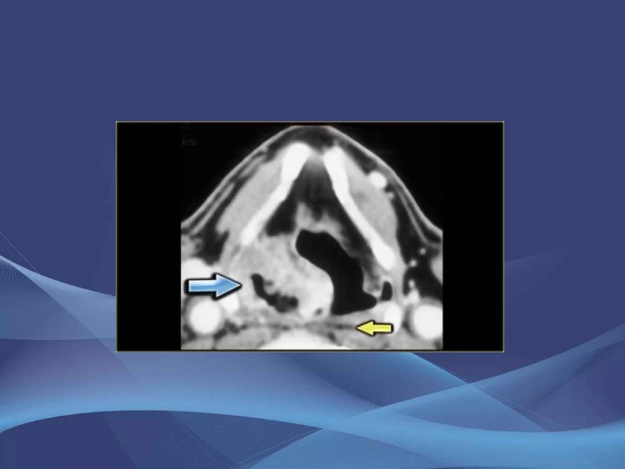 Anatomy of neck spaces and levels of cervical | PPT