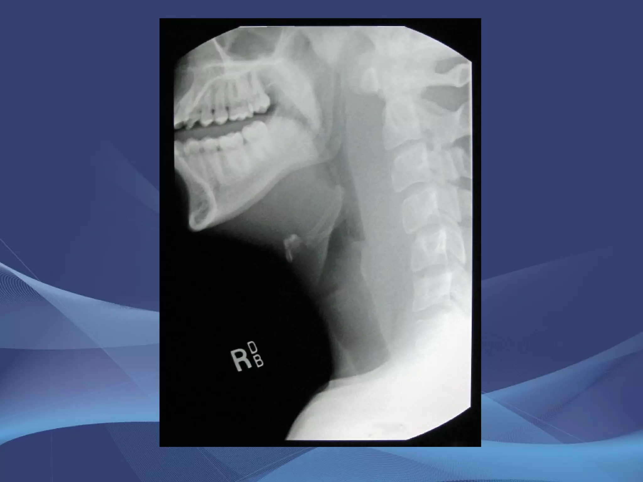 Anatomy of neck spaces and levels of cervical | PPT