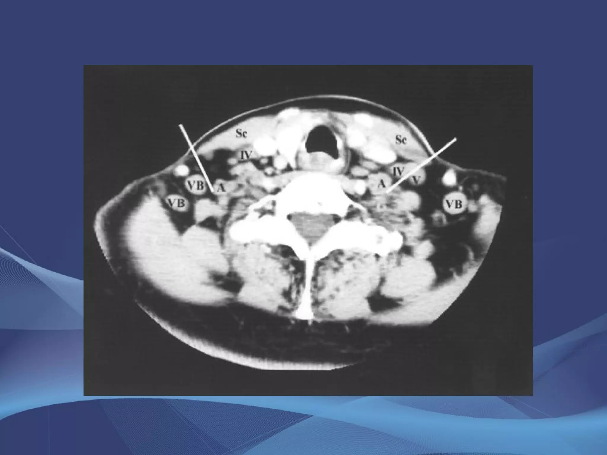 Anatomy of neck spaces and levels of cervical | PPT