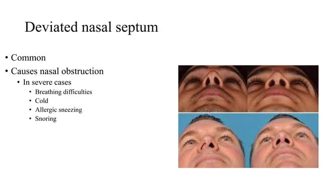Anatomy of nose | PPT
