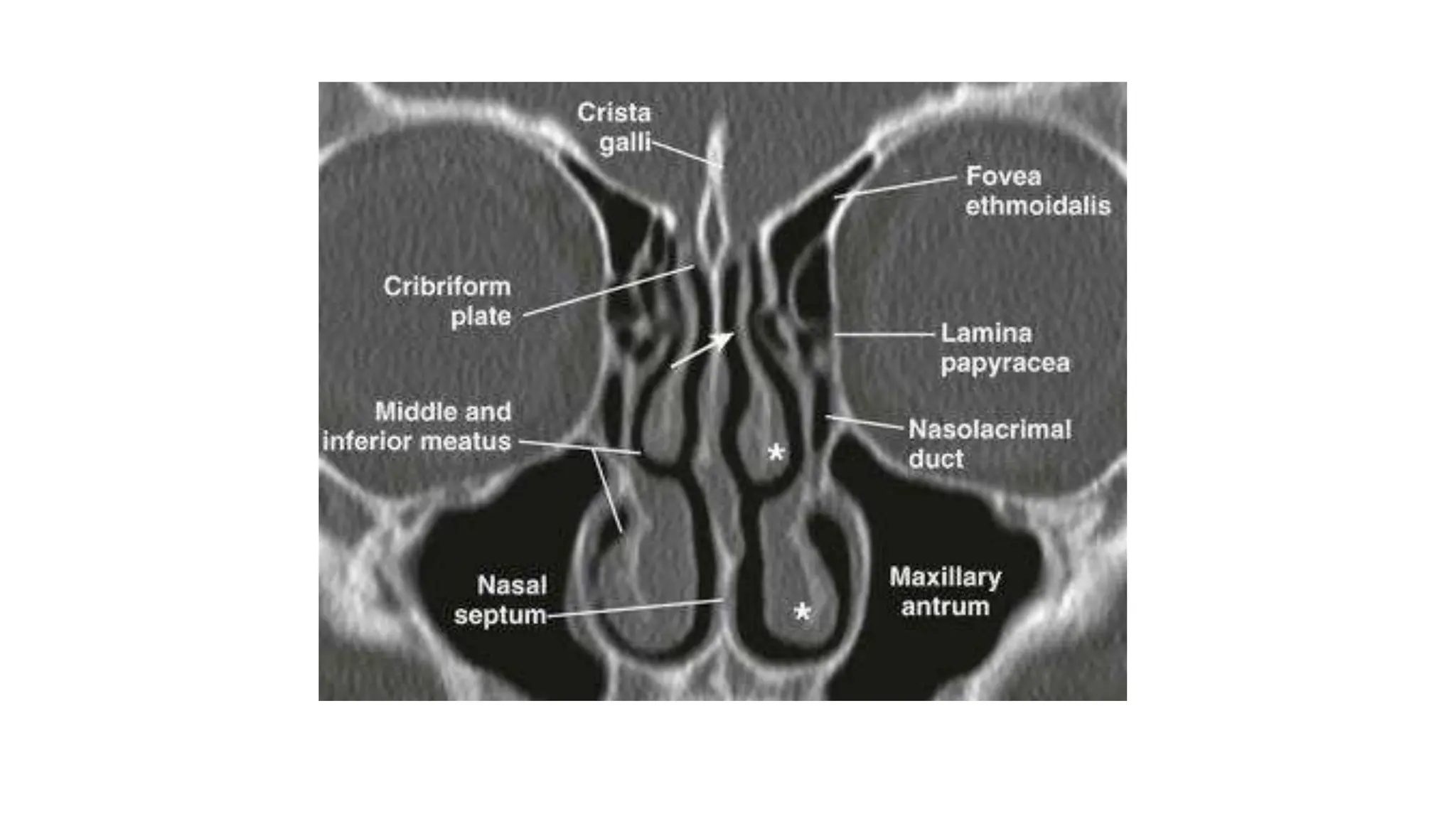 ANATOMY OF NOSE AND PARANASAL SINUSES.pptx