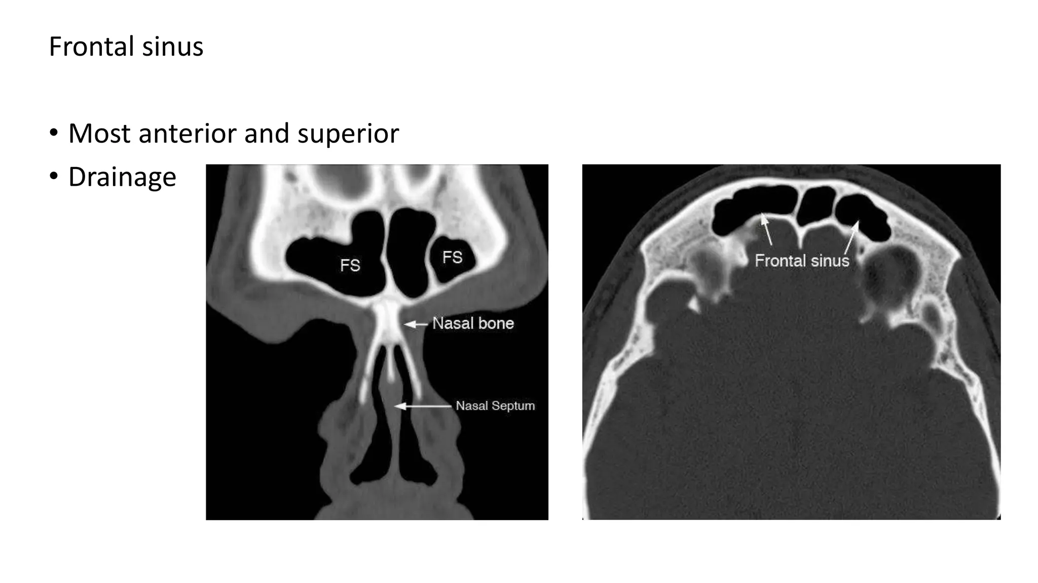 ANATOMY OF NOSE AND PARANASAL SINUSES.pptx