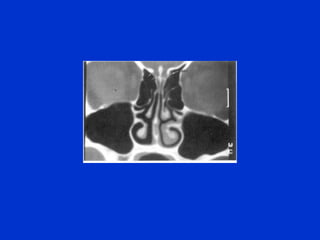 Anatomy of nose and paranasal sinuses | PPT