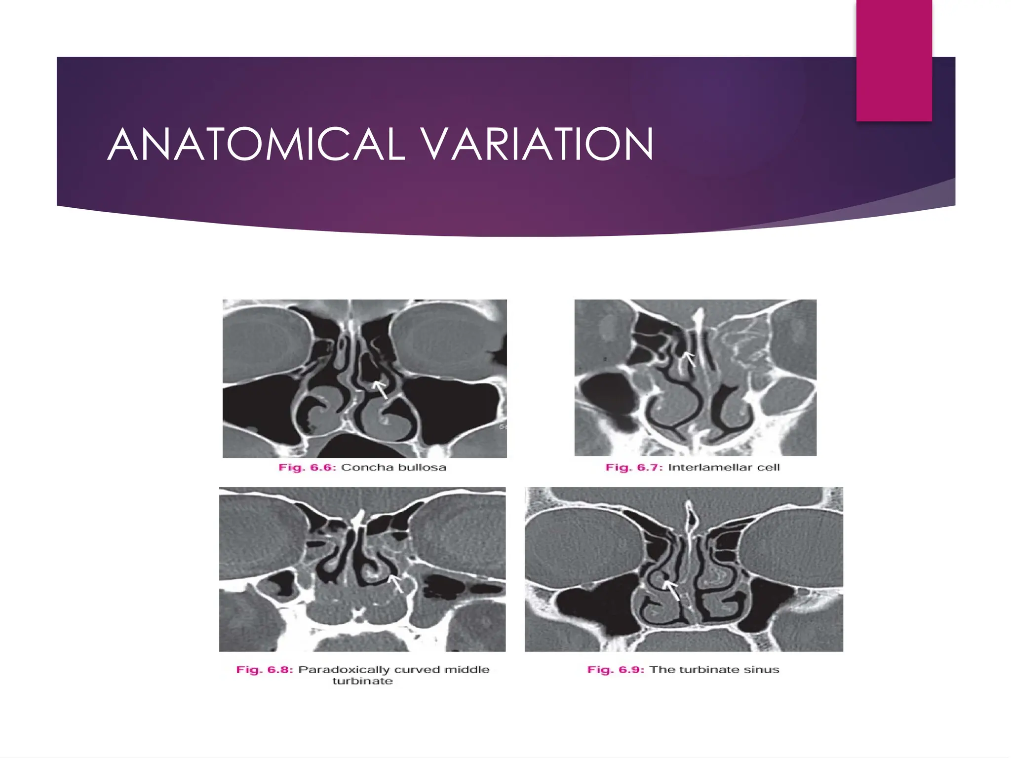 ANATOMY OF NOSE and PARANASAL SINUSES ENT PG | PPTX