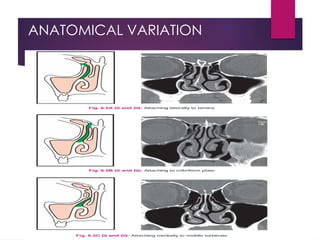 ANATOMY OF NOSE and PARANASAL SINUSES ENT PG | PPTX
