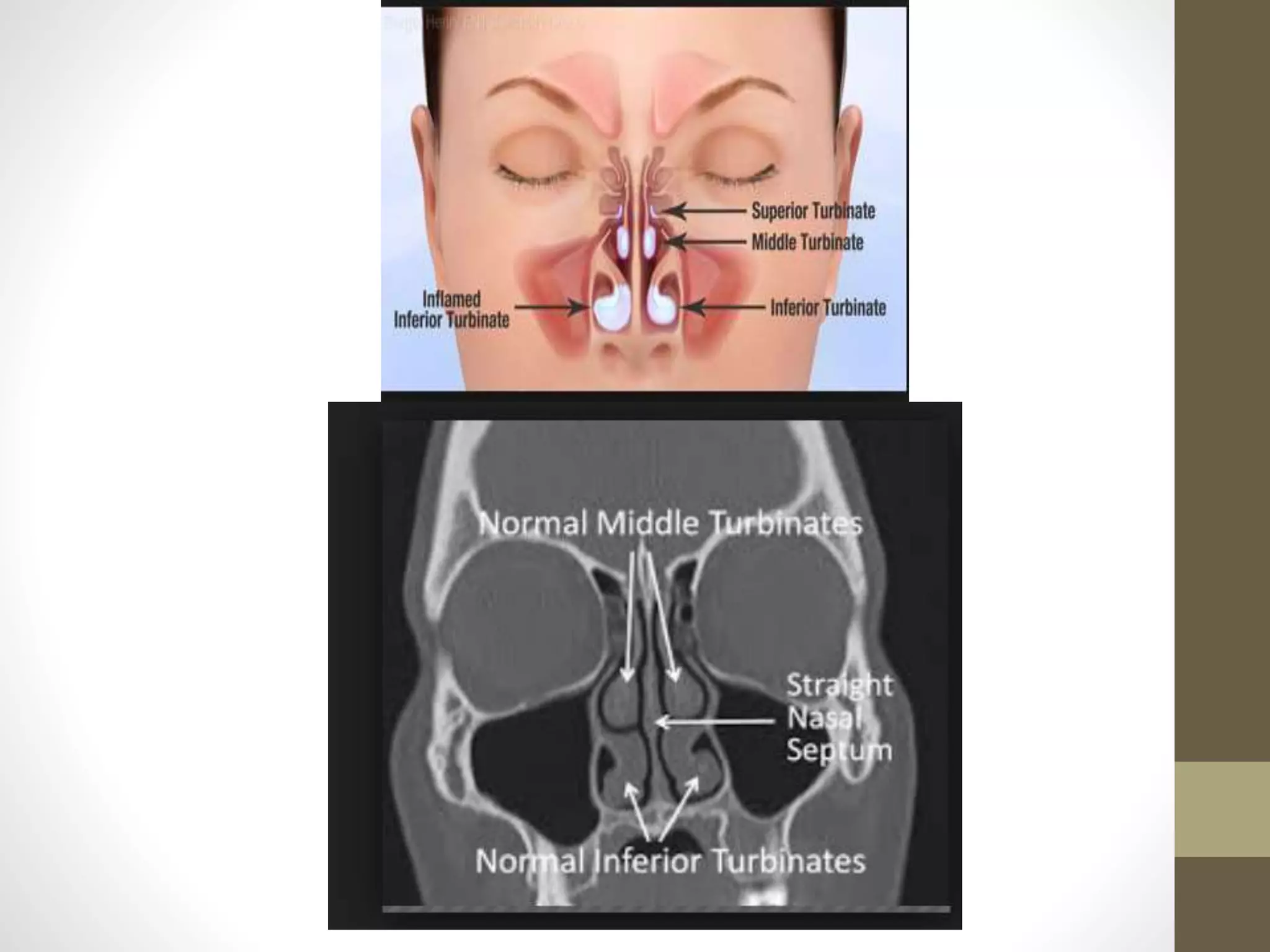 Anatomy of NASAL CAVITY related to FESS | PPT