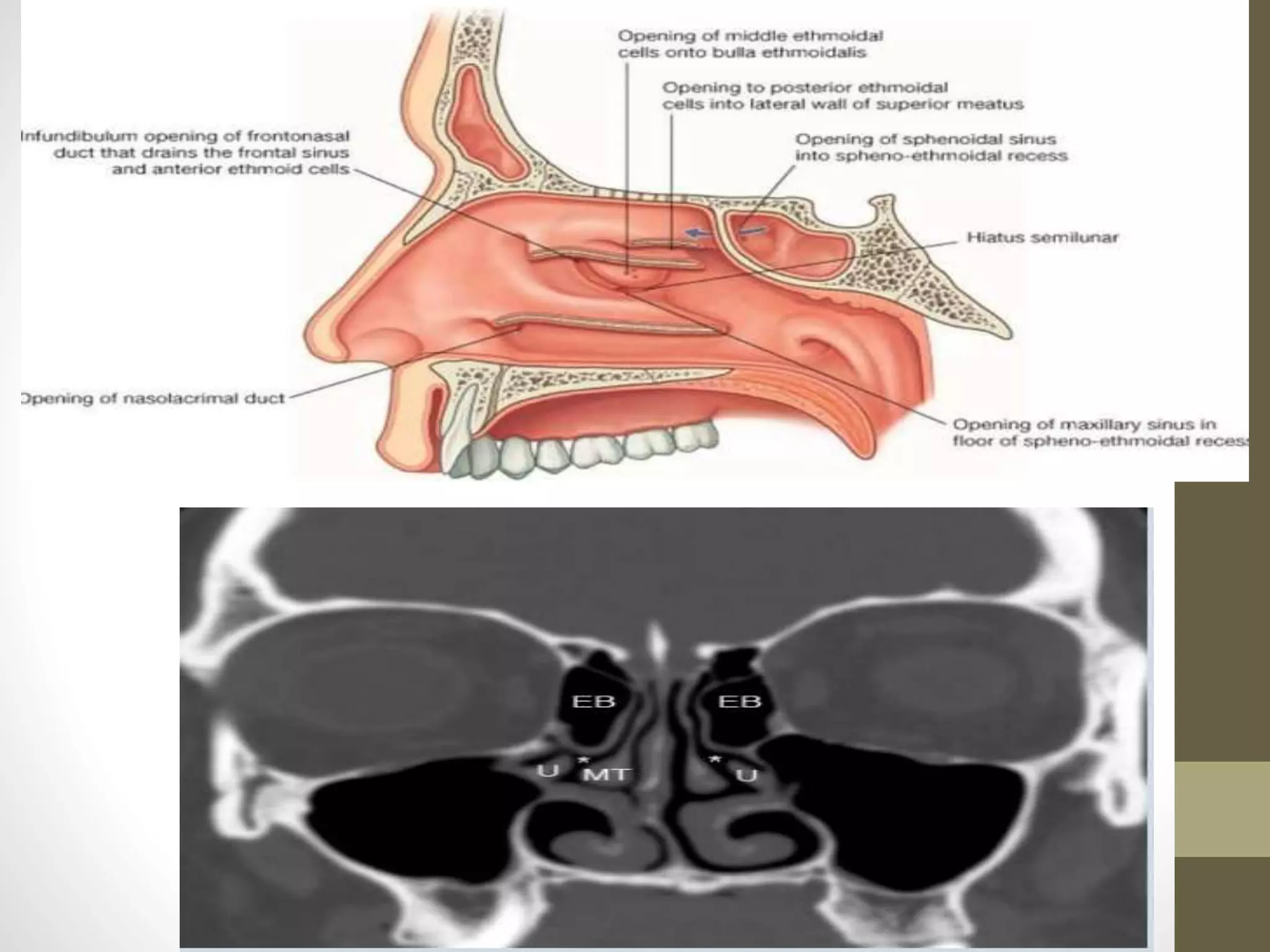 Anatomy of NASAL CAVITY related to FESS | PPTX