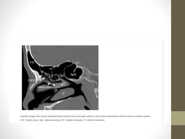 Anatomy of NASAL CAVITY related to FESS | PPT