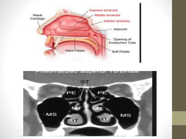 Anatomy of NASAL CAVITY related to FESS | PPT