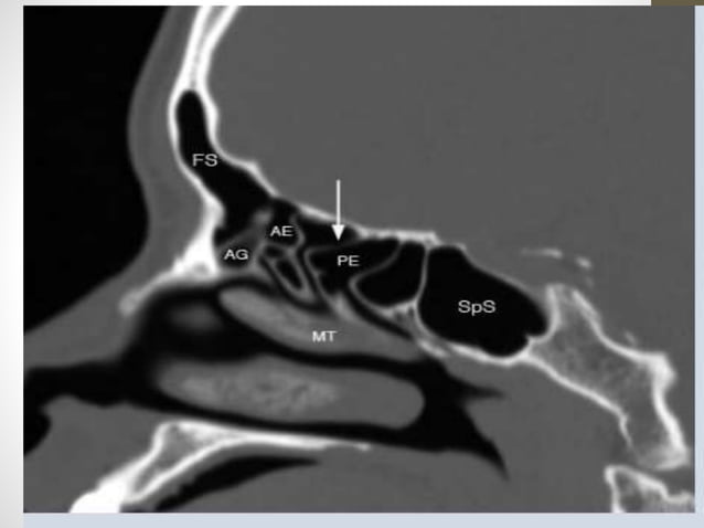 Anatomy of NASAL CAVITY related to FESS | PPT