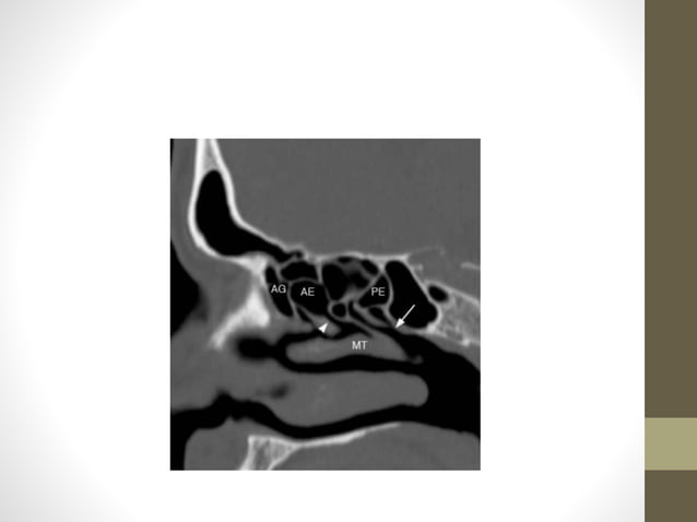 Anatomy of NASAL CAVITY related to FESS | PPT