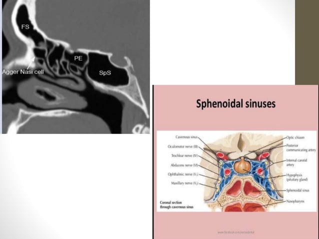 Anatomy of NASAL CAVITY related to FESS | PPT