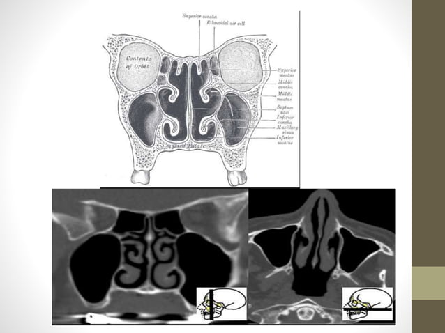 Anatomy of NASAL CAVITY related to FESS | PPT