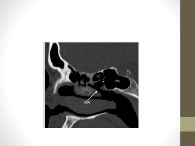 Anatomy of NASAL CAVITY related to FESS | PPT