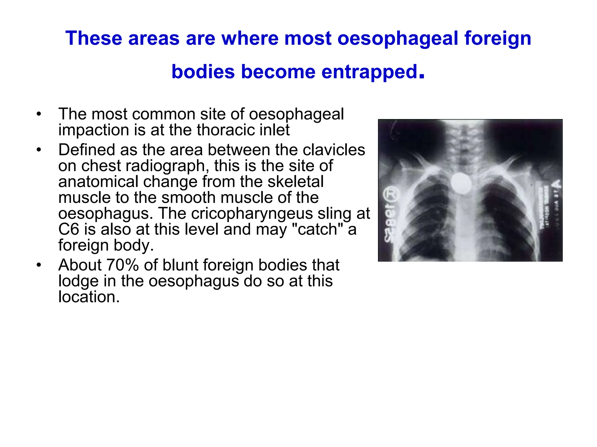 Anatomy of oesophagus.ppt including relations narrow points etc | PPT