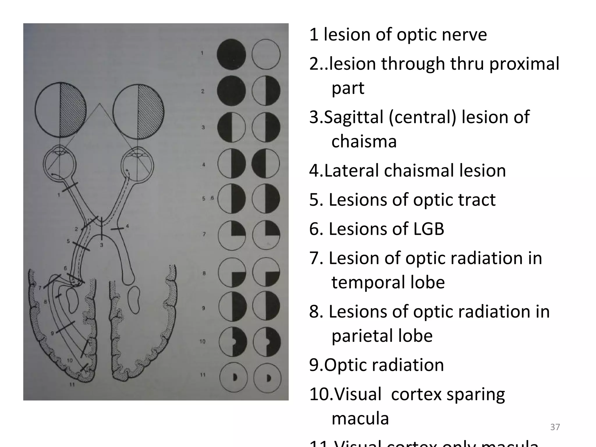 Anatomy of optic nerve and its clinical significance | PPT