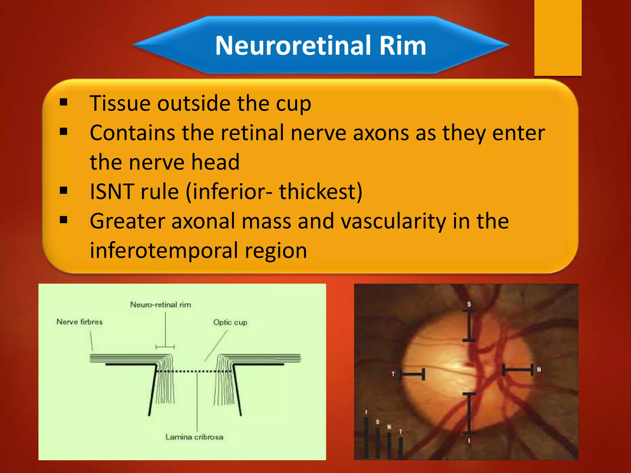 Anatomy of optic nerve (Optic Nerve Anatomy), Blood Supply & Clinical ...