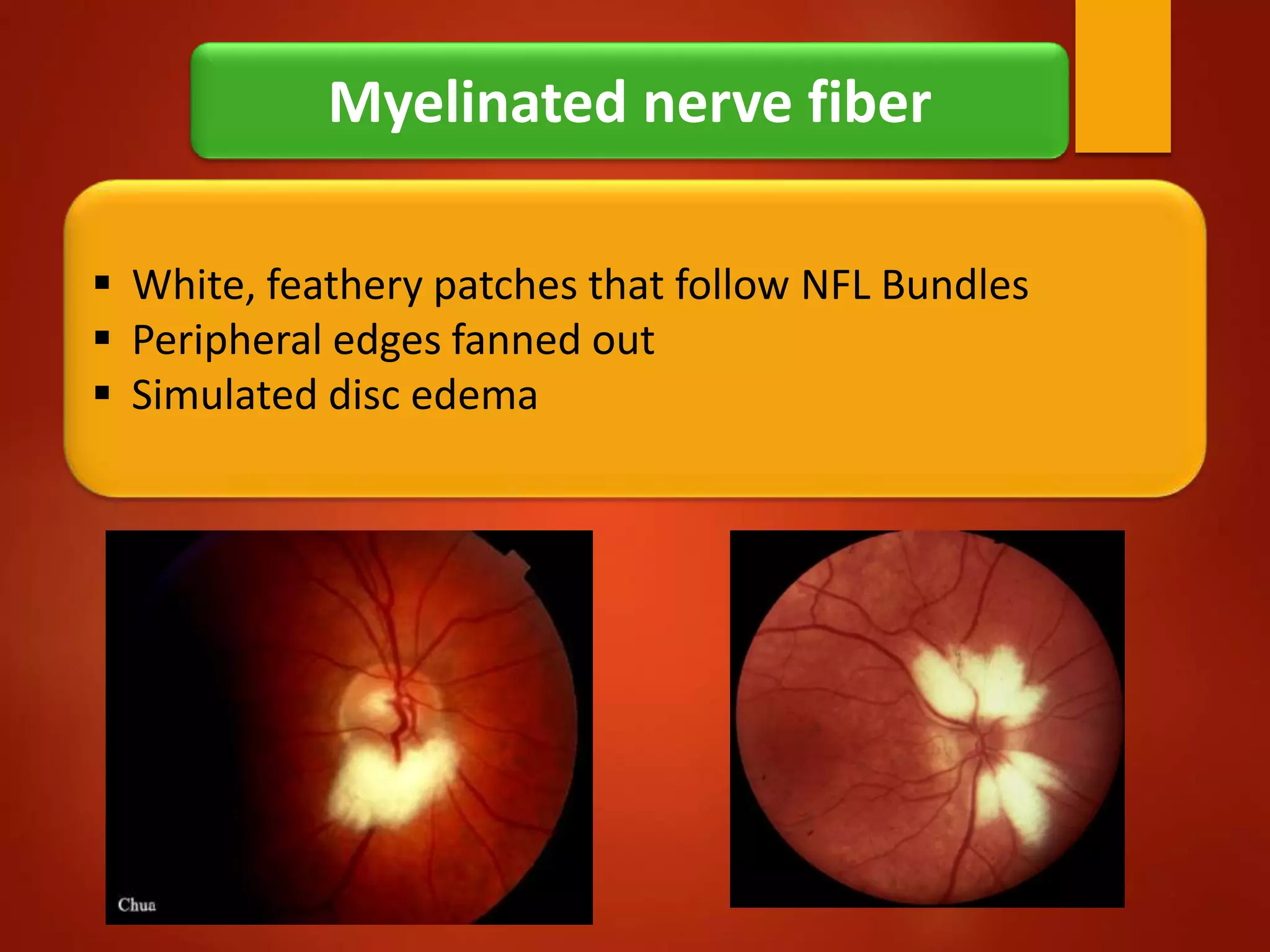 Anatomy of optic nerve (Optic Nerve Anatomy), Blood Supply & Clinical ...