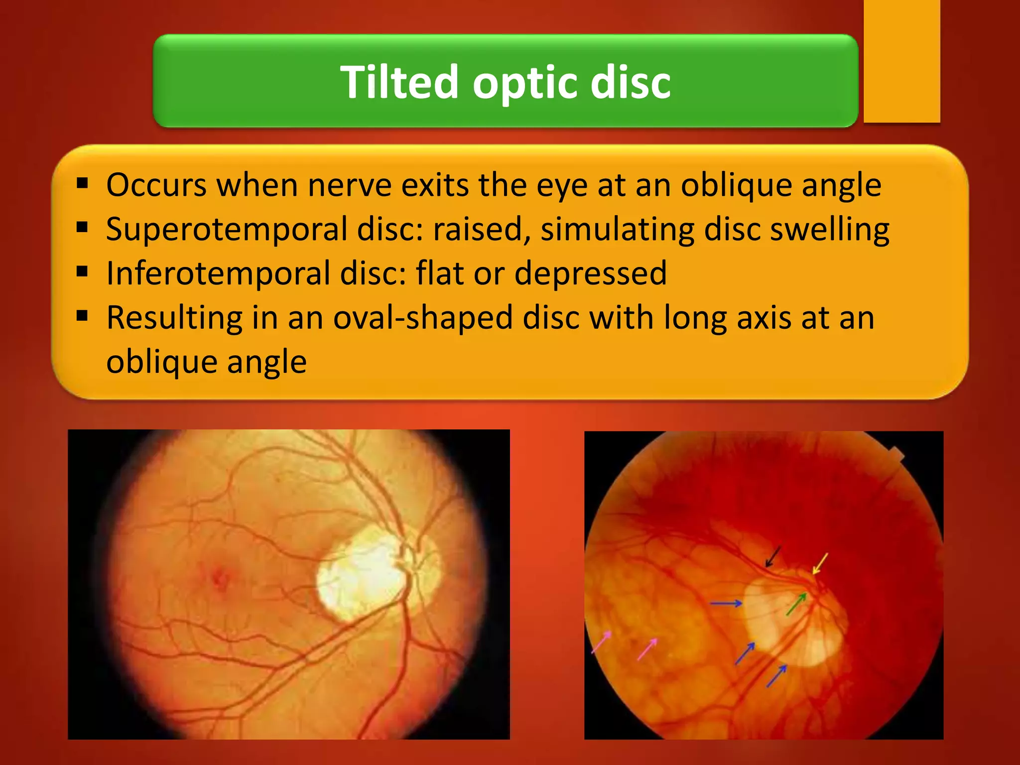 Anatomy of optic nerve (Optic Nerve Anatomy), Blood Supply & Clinical ...