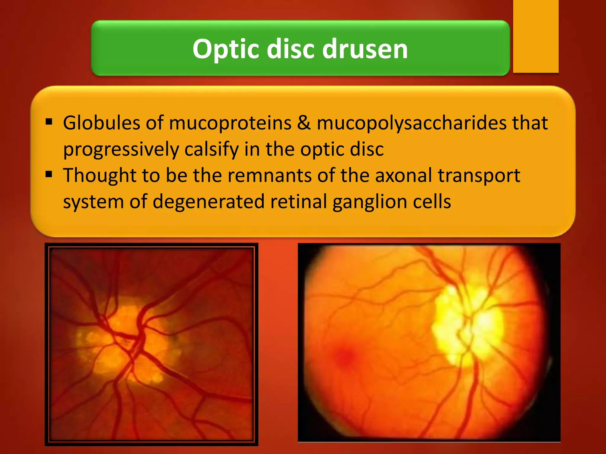 Anatomy of optic nerve (Optic Nerve Anatomy), Blood Supply & Clinical ...