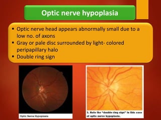 Anatomy of optic nerve (Optic Nerve Anatomy), Blood Supply & Clinical ...
