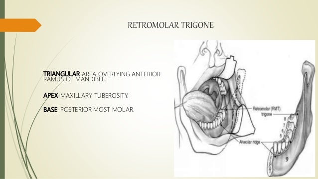 Trigono Retromolar Inchado
