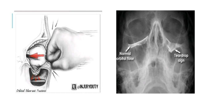Anatomy of orbit ophthalm | PPTX