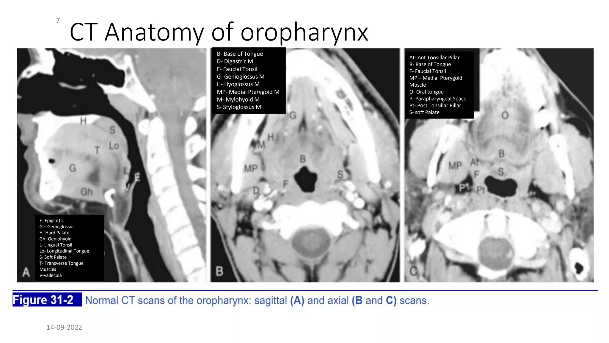 Anatomy & Lymphatic Drainage of Oropharynx.pptx