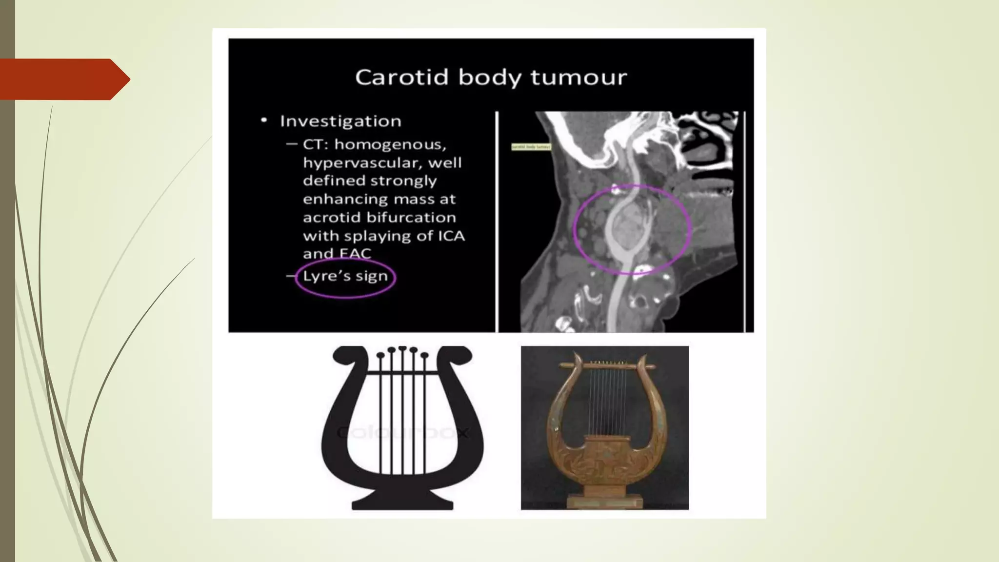Anatomy of parapharyngeal space and its tumours | PPTX