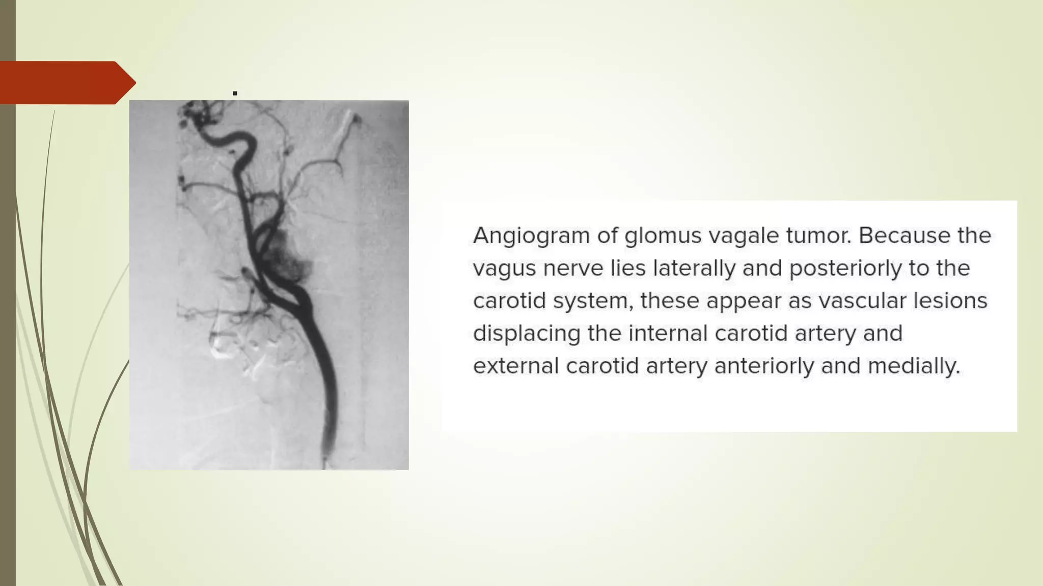 Anatomy of parapharyngeal space and its tumours | PPTX
