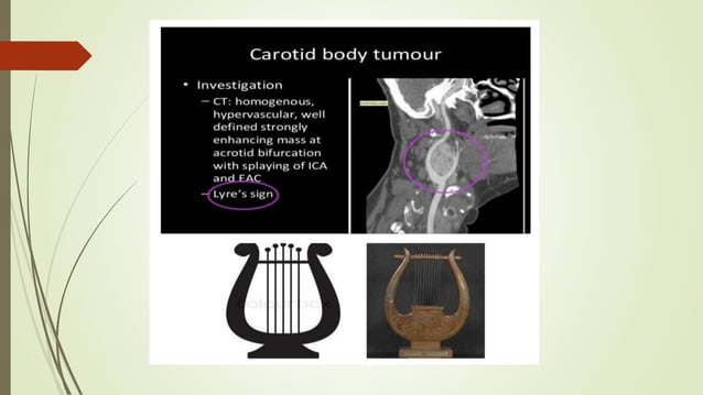 Anatomy of parapharyngeal space and its tumours | PPTX | Ear, Nose and ...