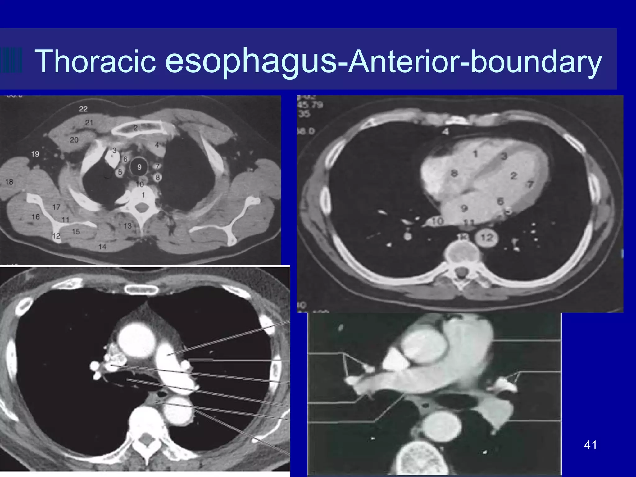Radiological Anatomy of pharynx and esophagus abdul final | PDF