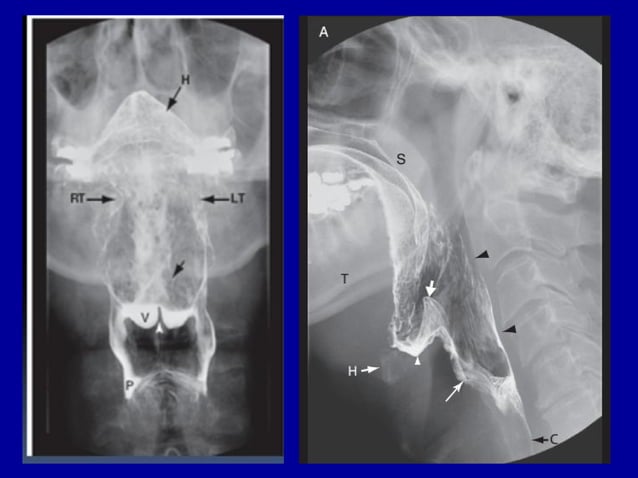 Radiological Anatomy of pharynx and esophagus abdul final | PDF