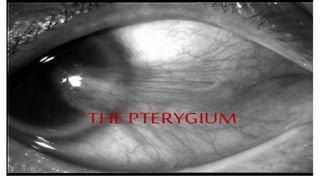 Anatomy of Pterygium.pptx