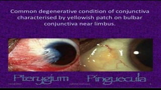 Anatomy of Pterygium.pptx