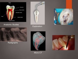 Anatomy of pulp space | PPTX