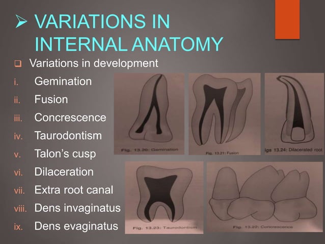 Anatomy of pulp space | PPTX | Dental Health | Diseases and Conditions