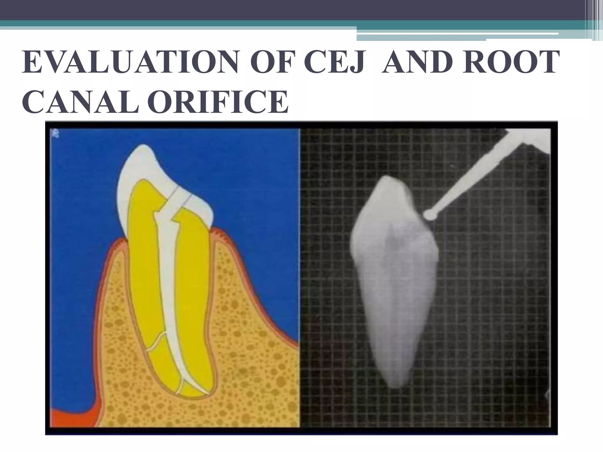 Anatomy of pulp canal and its access opening | PPTX