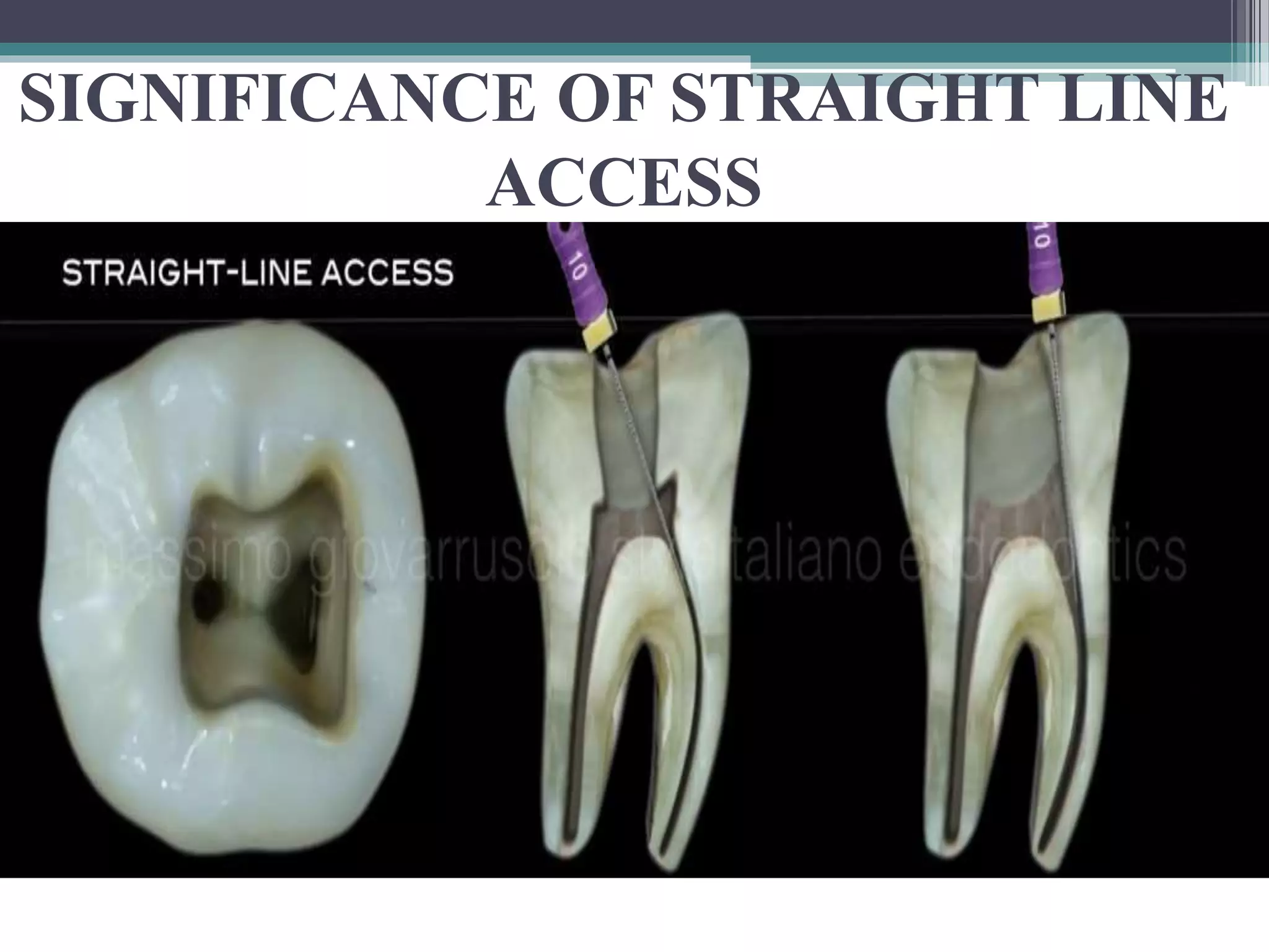 Anatomy of pulp canal and its access opening | PPTX