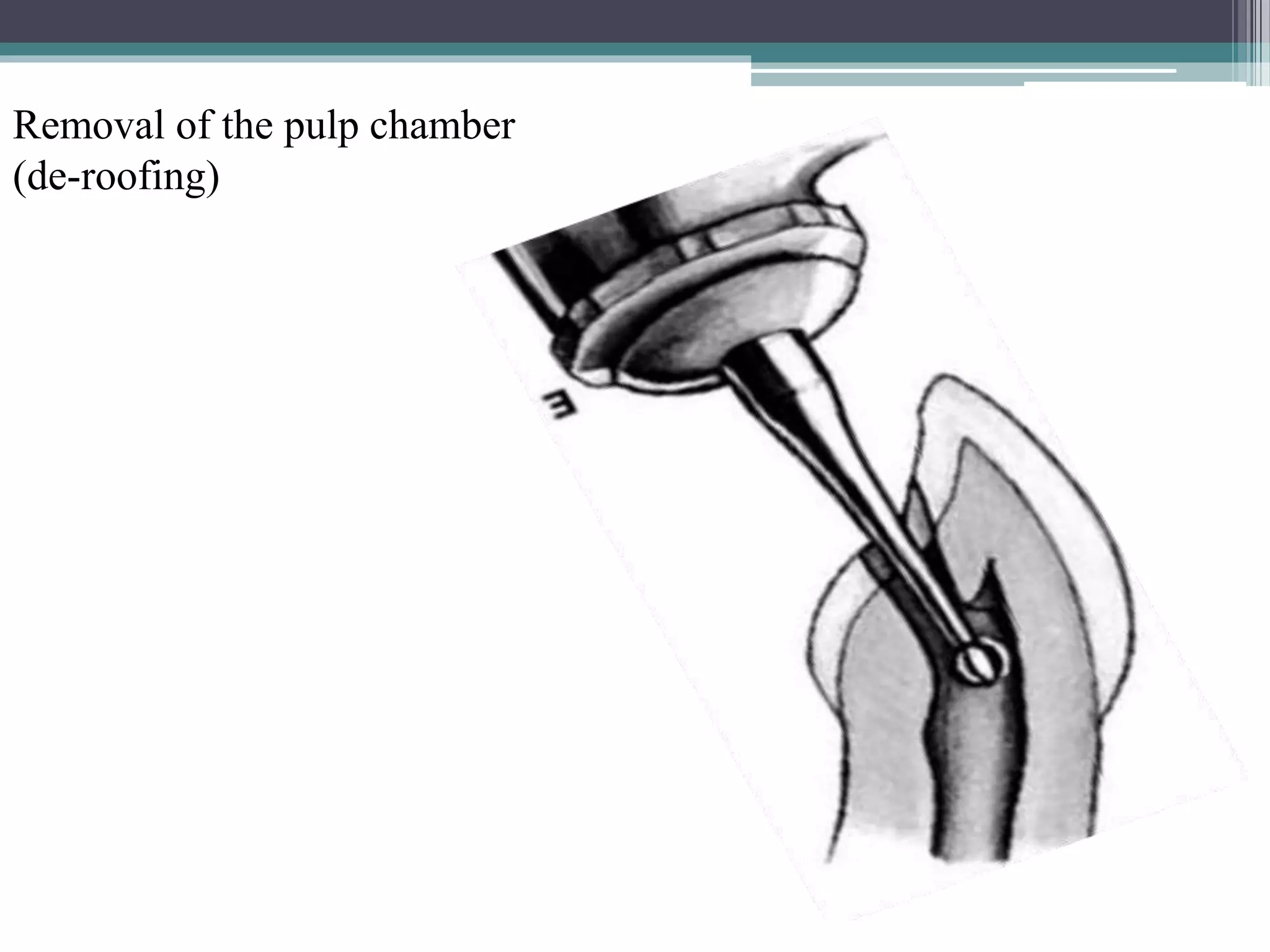 Anatomy of pulp canal and its access opening | PPT