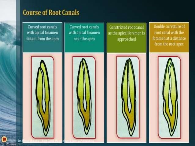 Anatomy of pulp canal and its access opening | PPT